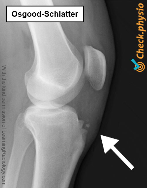 Osgood-Schlatter | Causa, síntomas y tratamiento