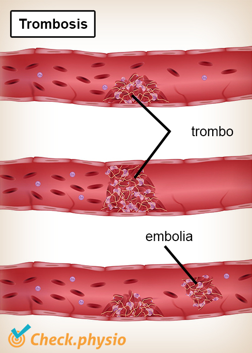 Trombosis de la pierna | Causa, síntomas y tratamiento